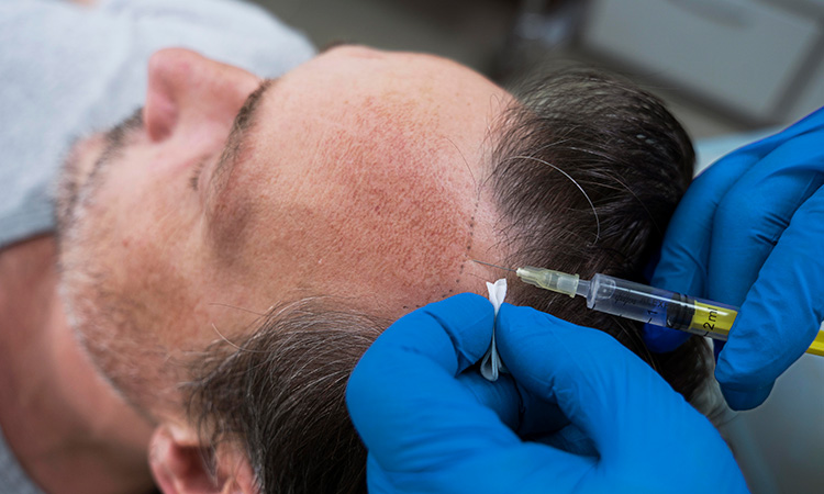 The Future of Hair Restoration: Exploring the Benefits of FUE Hair ...